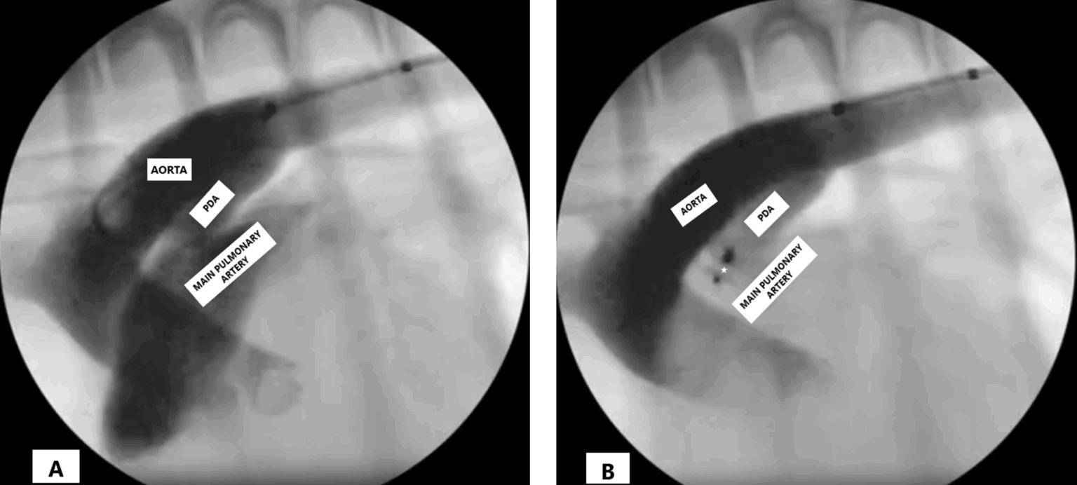 Patent Ductus Arteriosus (PDA) in Small Animals - American College of ...