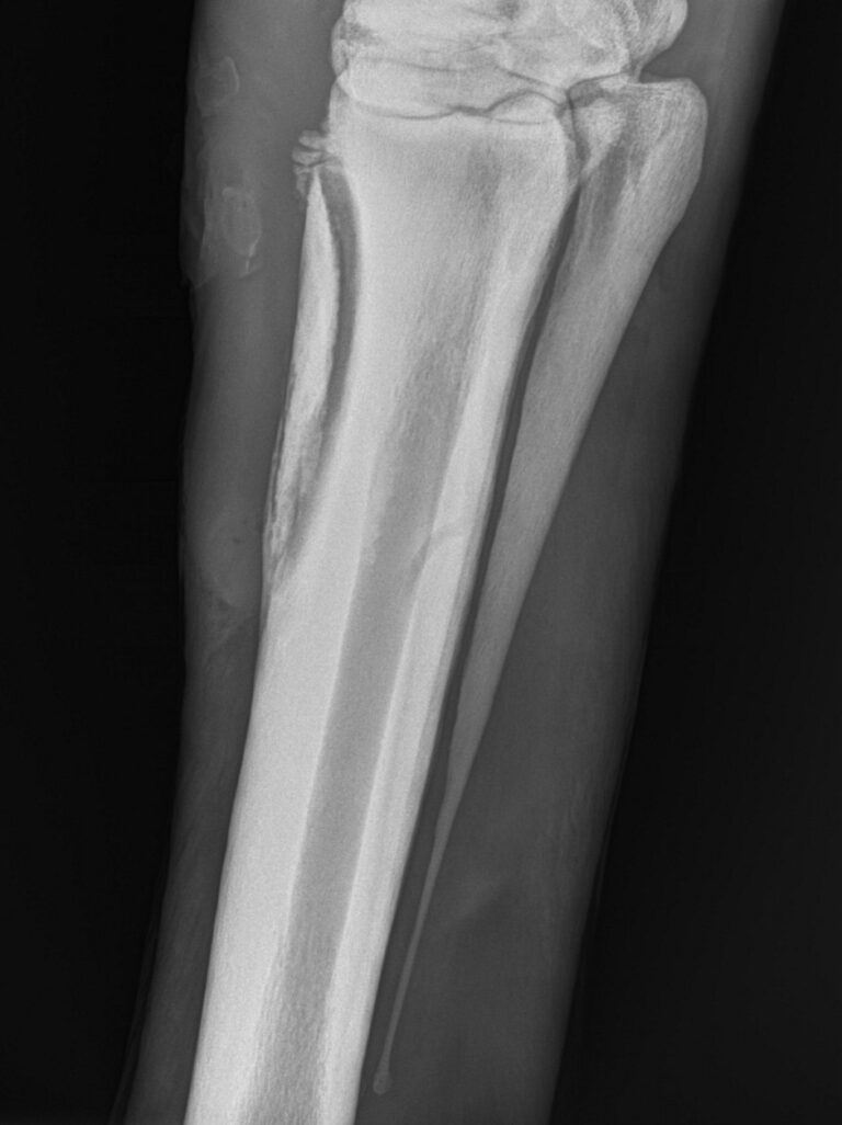 Bone Sequestrum in Large Animals - American College of Veterinary Surgeons